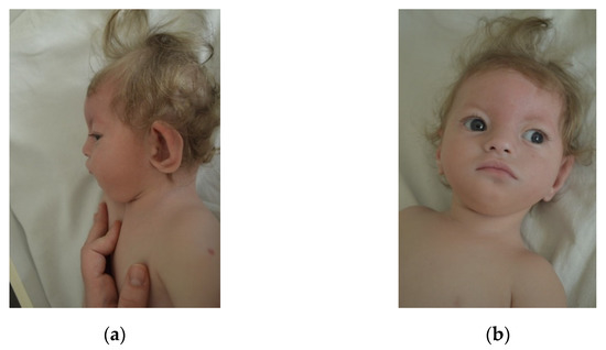 Wolf-Hirschhorn Syndrome: Clinical and Genetic Study of 7 New Cases ...