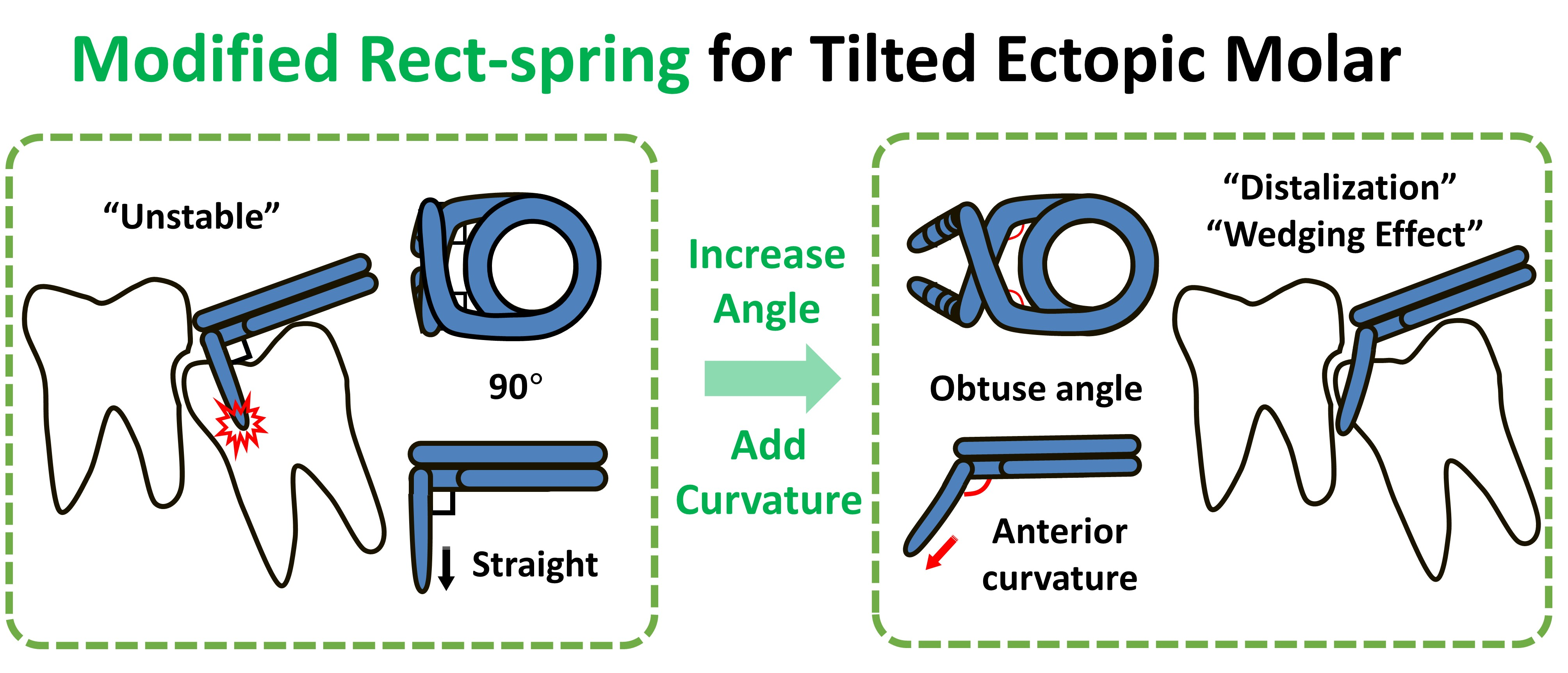 Children | Free Full-Text | Modifications of Rect-Spring to Enhance the ...