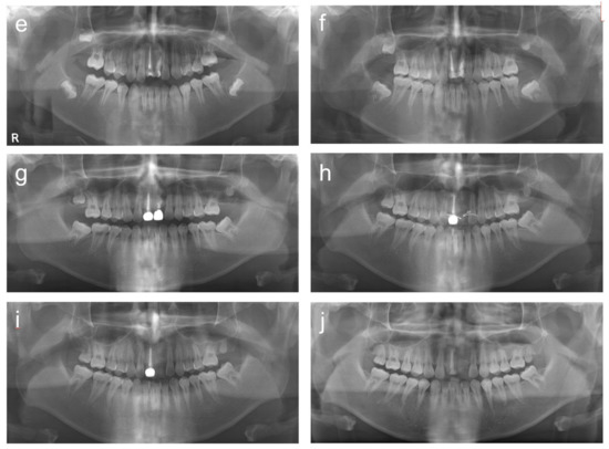 Management of Severely Aberrant Permanent First Molars in Molar Root ...