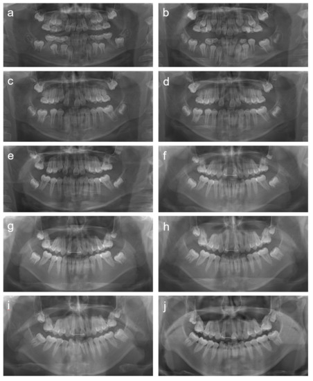 Management of Severely Aberrant Permanent First Molars in Molar Root ...