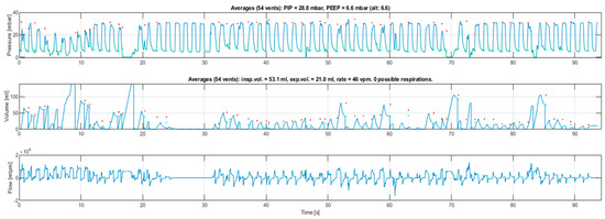 Novel Neonatal Simulator Provides High-Fidelity Ventilation Training ...
