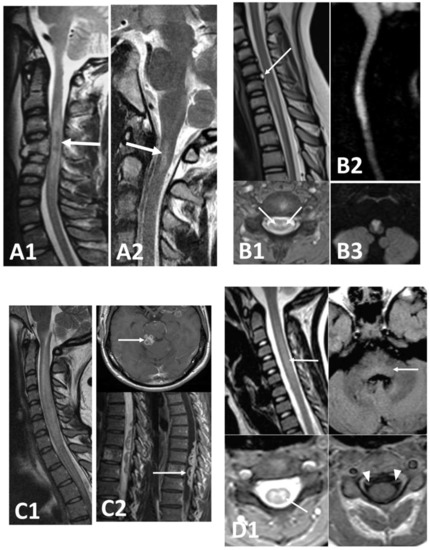Acute Myelopathy in Childhood