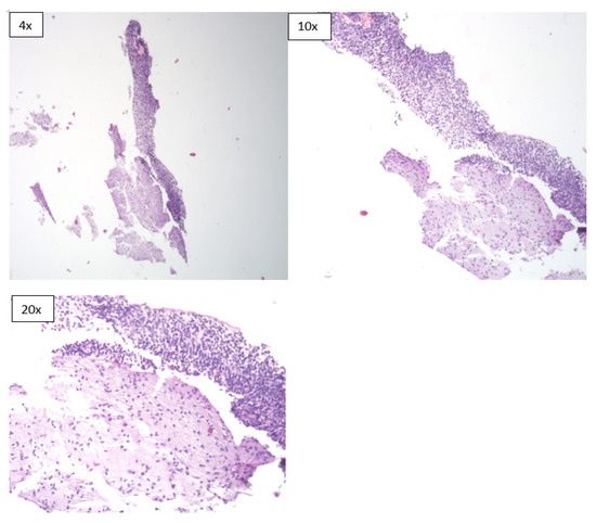 Validating a Minimally Invasive Tissue Sampling (MITS) Method in ...