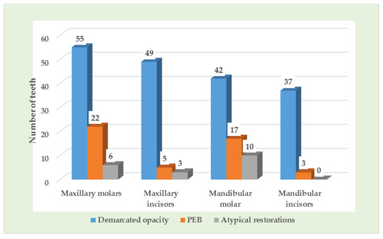 Hypomineralized Primary Teeth in Preterm Low Birth Weight Children and ...
