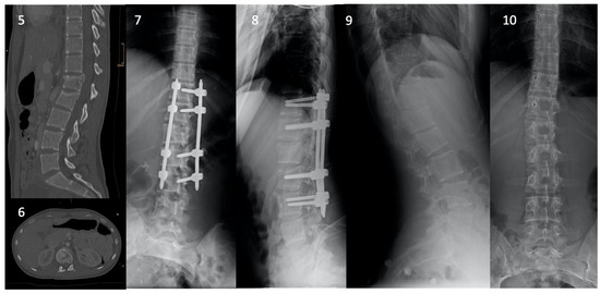 Spine Fractures in Children and Adolescents—Frequency, Causes ...