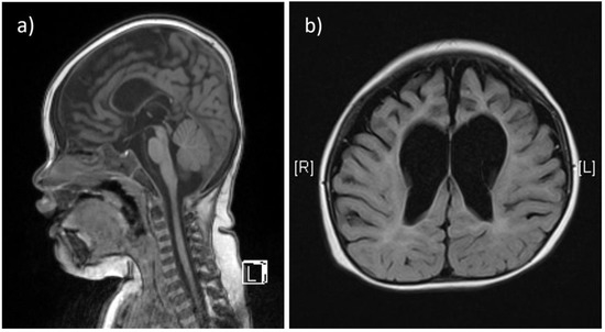 Novel Compound Heterozygous Variants in TBCD Gene Associated with ...