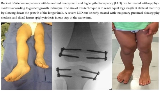 Children | Free Full-Text | Guided Growth in Leg Length Discrepancy in ...