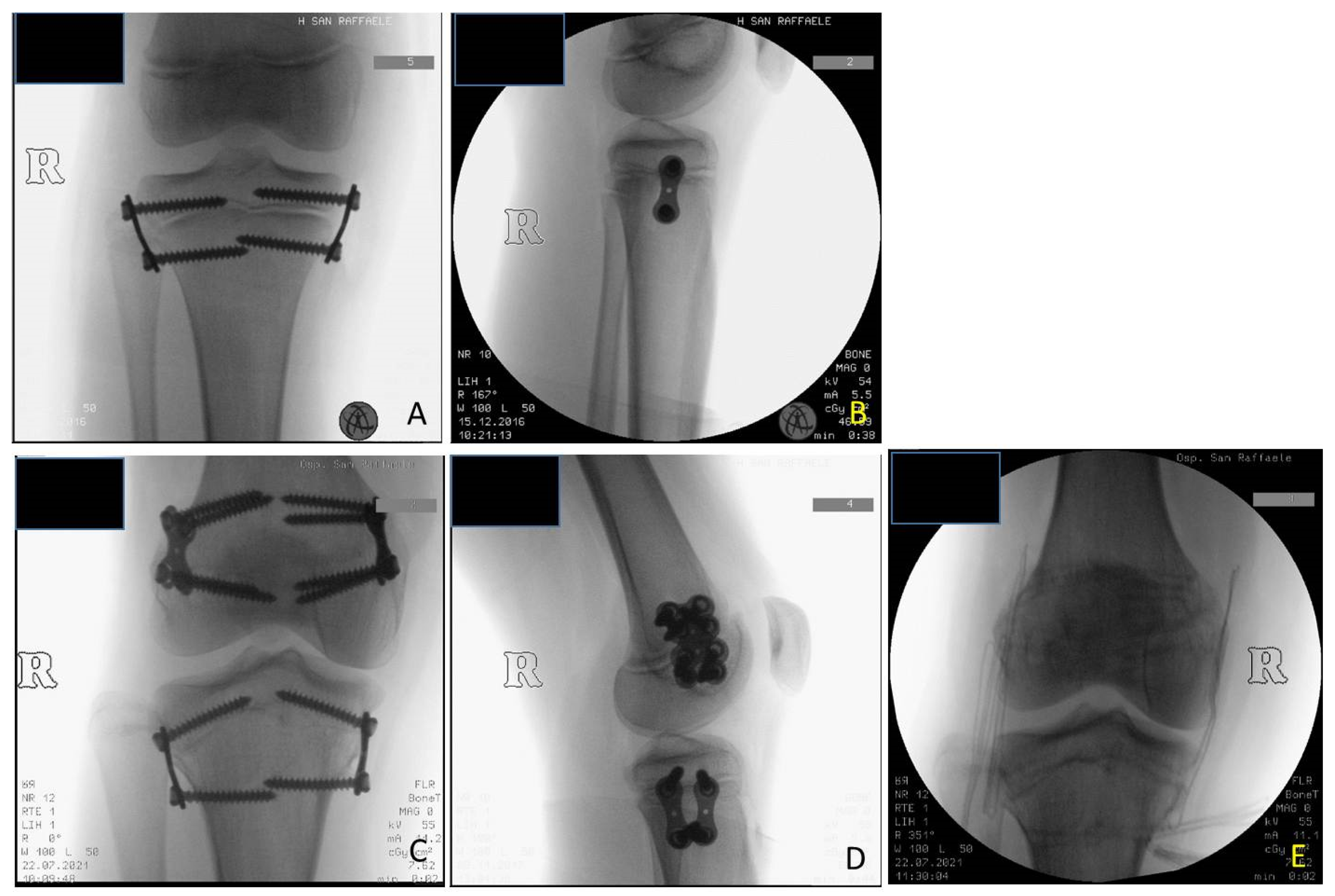 Guided Growth in Leg Length Discrepancy in Beckwith-Wiedemann Syndrome ...