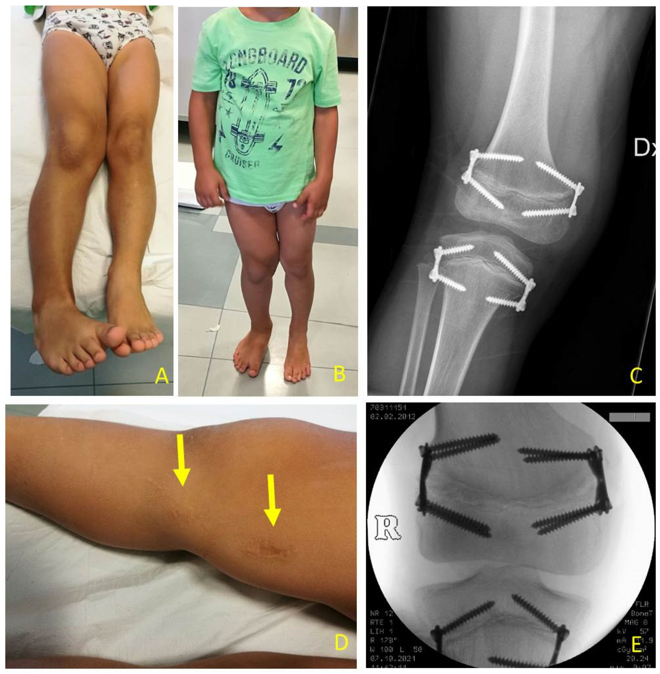 Guided Growth in Leg Length Discrepancy in Beckwith-Wiedemann Syndrome ...