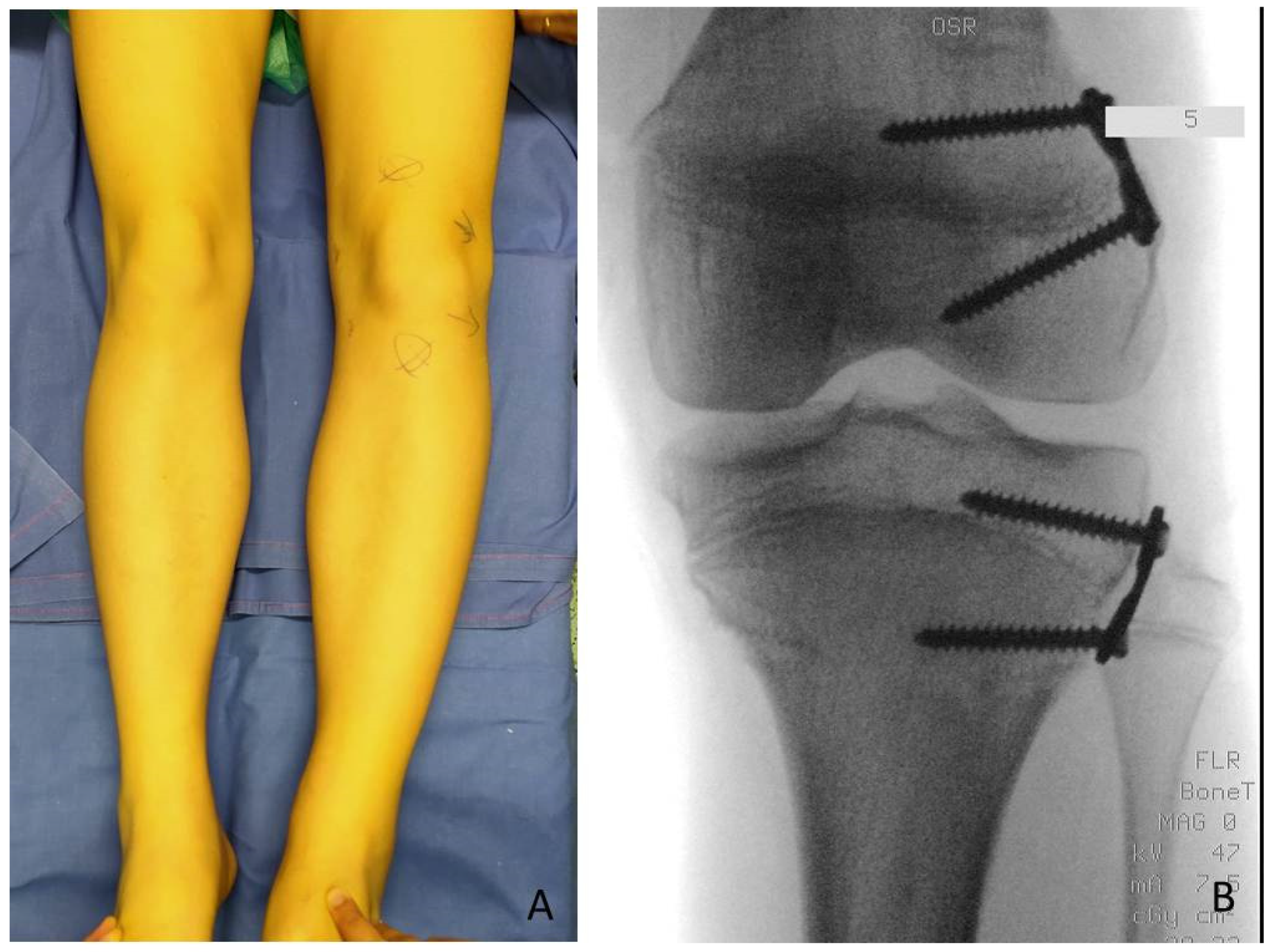 Guided Growth in Leg Length Discrepancy in Beckwith-Wiedemann Syndrome ...