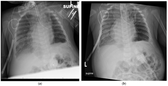 Novel Use of a Bronchial Blocker in a Challenging Case of Congenital ...