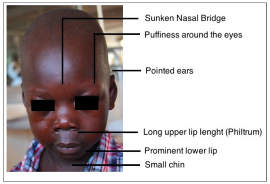 A Case of William’s Syndrome in a Ugandan Child: A Feasible Diagnosis ...