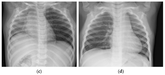 Rigid Bronchoscopy in Foreign Body Aspiration Diagnosis and Treatment ...