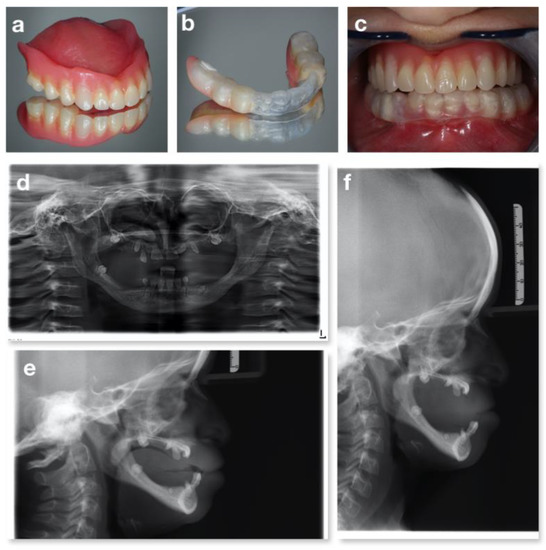 Rare Genetic Syndromes and Oral Anomalies: A Review of the Literature ...
