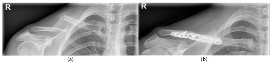 Pediatric Clavicle Fractures and Congenital Pseudarthrosis Unraveled
