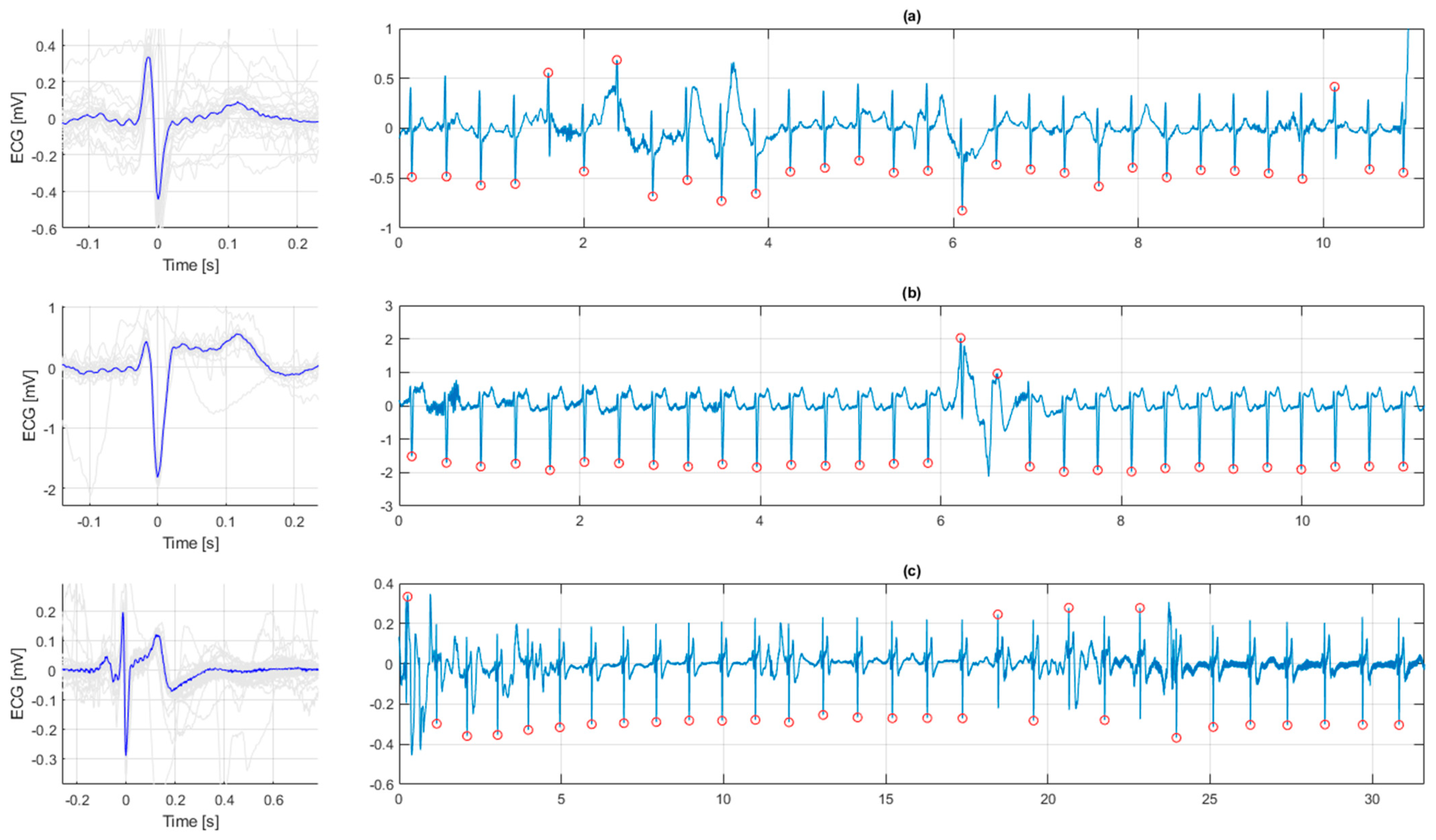 Delivery Room ST Segment Analysis to Predict Short Term Outcomes in ...