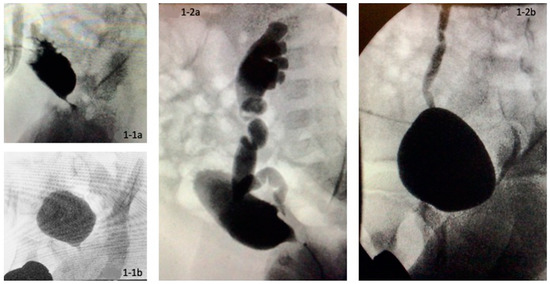 Is Vesicostomy Still a Contemporary Method of Managing Posterior ...