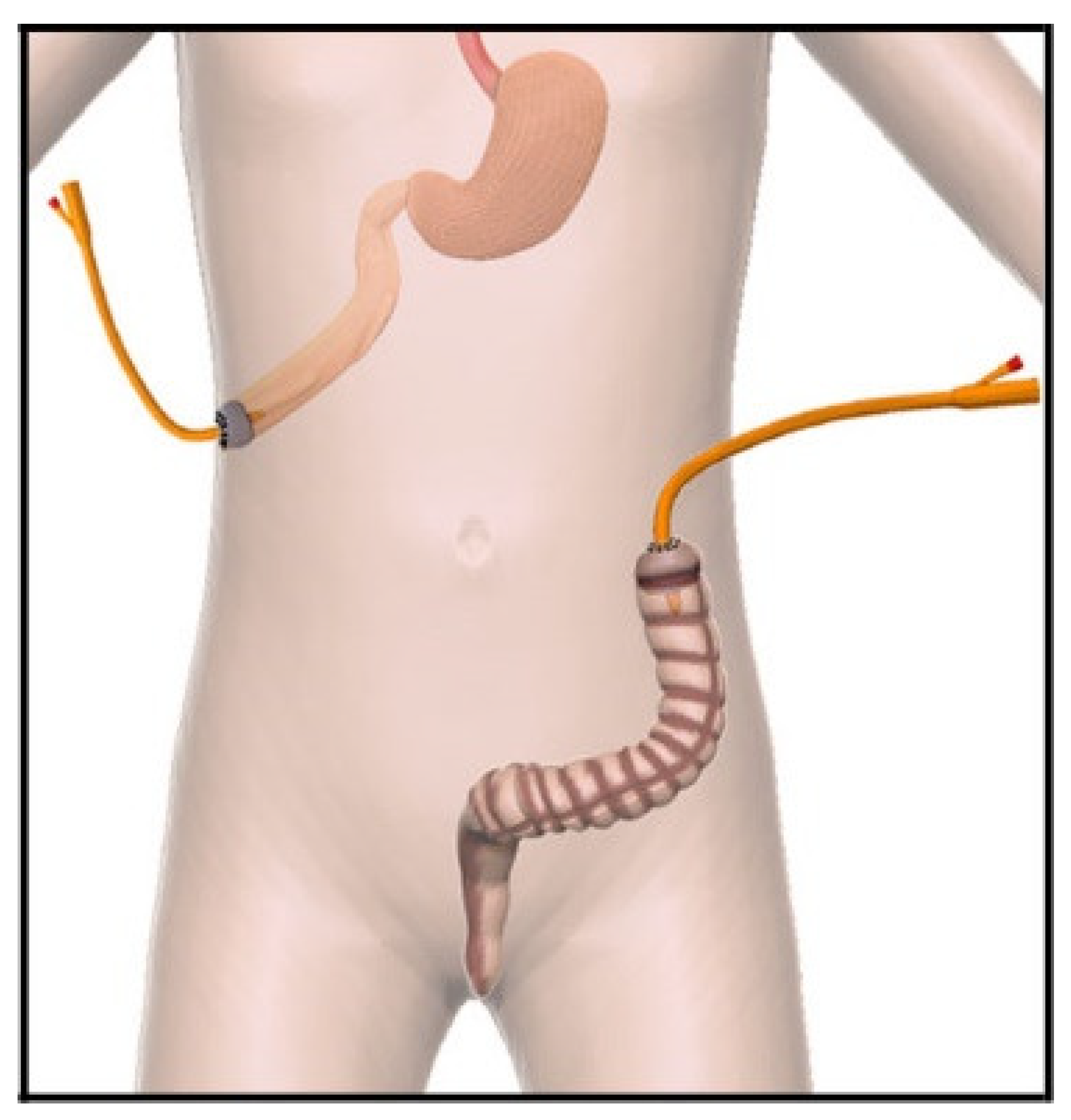 Loop Ileostomy Closure