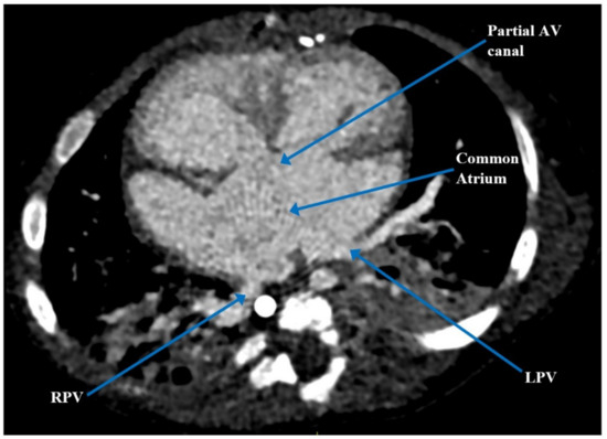 Utility of Three-Dimensional Printed Model in Biventricular Repair of ...