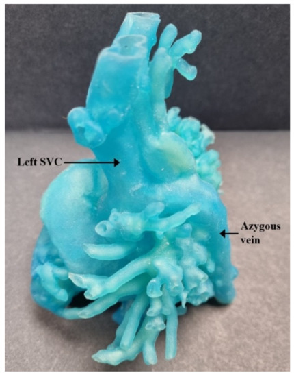 Utility of Three-Dimensional Printed Model in Biventricular Repair of ...