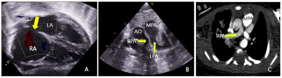 Right Pulmonary Artery Originating from Ascending Aorta (Hemitruncus ...