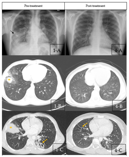 Use of Intravenous Pulse Steroids to Treat Allergic Bronchopulmonary ...