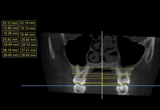 Children | Free Full-Text | Comparison between Digital Casts and Cone ...