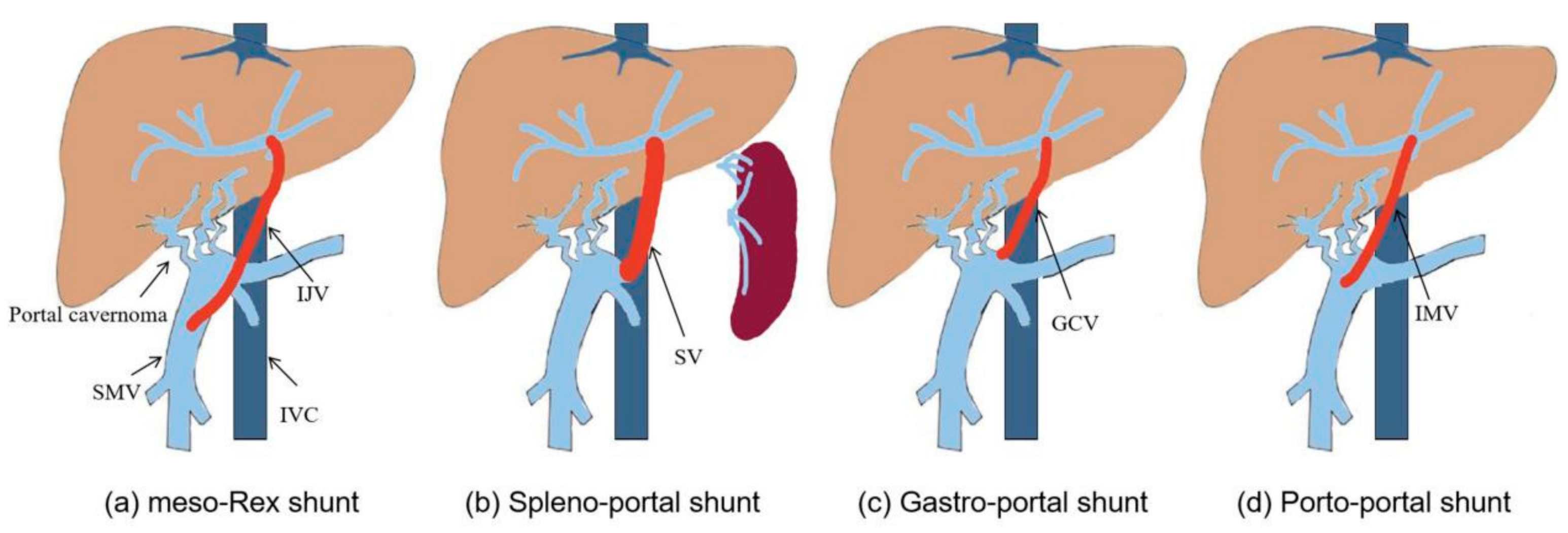 Rex Shunt for Extra-Hepatic Portal Venous Obstruction in Children