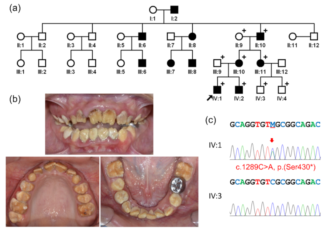 A Recurrent FAM83H Mutation in an Extended Colombian Family and ...