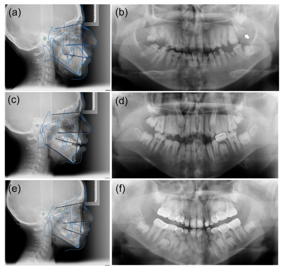 A Recurrent FAM83H Mutation in an Extended Colombian Family and ...