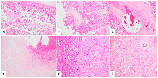 Influence of Maternal Region of Birth on Placental Pathology of Babies ...