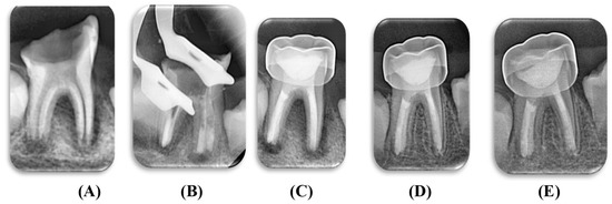 Comparison of MTA versus Biodentine in Apexification Procedure for ...