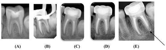 Comparison of MTA versus Biodentine in Apexification Procedure for ...