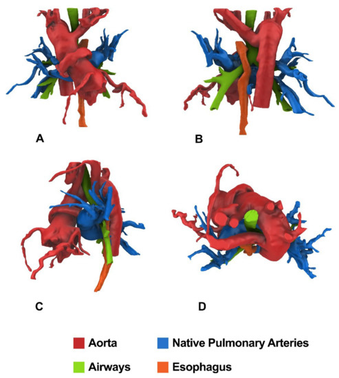 Children | Free Full-Text | The Modern Surgical Approach to Pulmonary ...