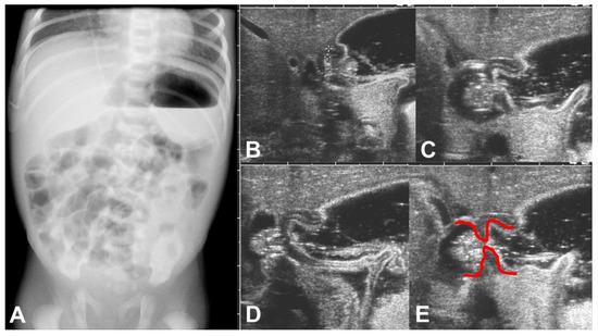 Congenital Hypertrophic Pyloric Stenosis in a Preterm Dizygotic Female ...