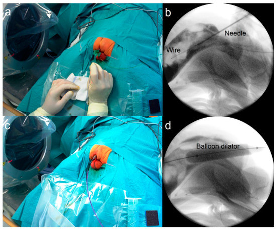Percutaneous Anorectoplasty (PARP)—An Adaptable, Minimal-Invasive ...