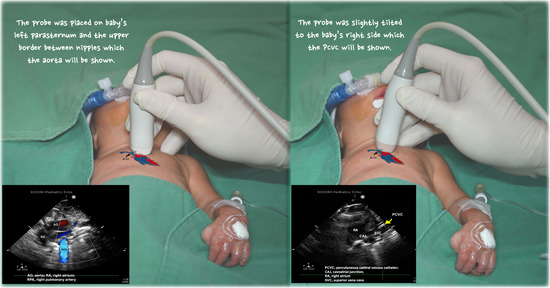 Children | Free Full-Text | Echocardiographic Determination of ...