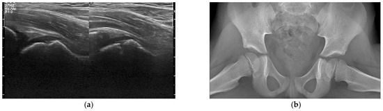 Pelvic Pyomyositis in Childhood: Clinical and Radiological Findings in ...