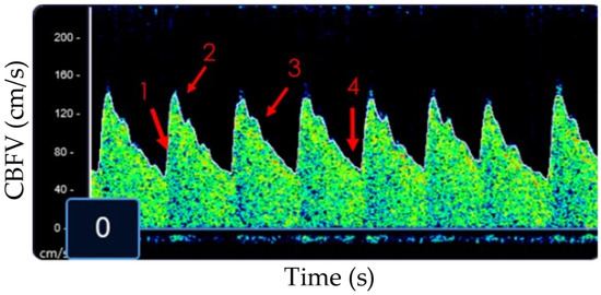 Transcranial Doppler Ultrasound, a Review for the Pediatric Intensivist