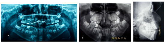 Children | Free Full-Text | Treatment of an Avulsed and Ankylosed ...