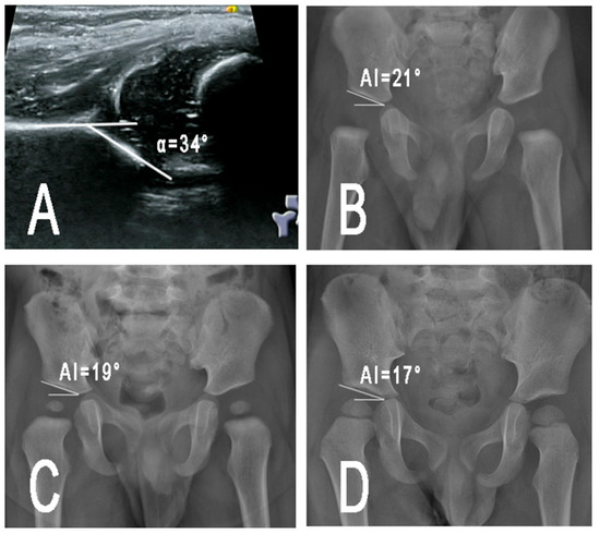 Does a Graf Type-I Hip Justify the Discontinuation of Pavlik Harness ...