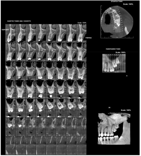 Teeth Eruption Disorders: A Critical Review