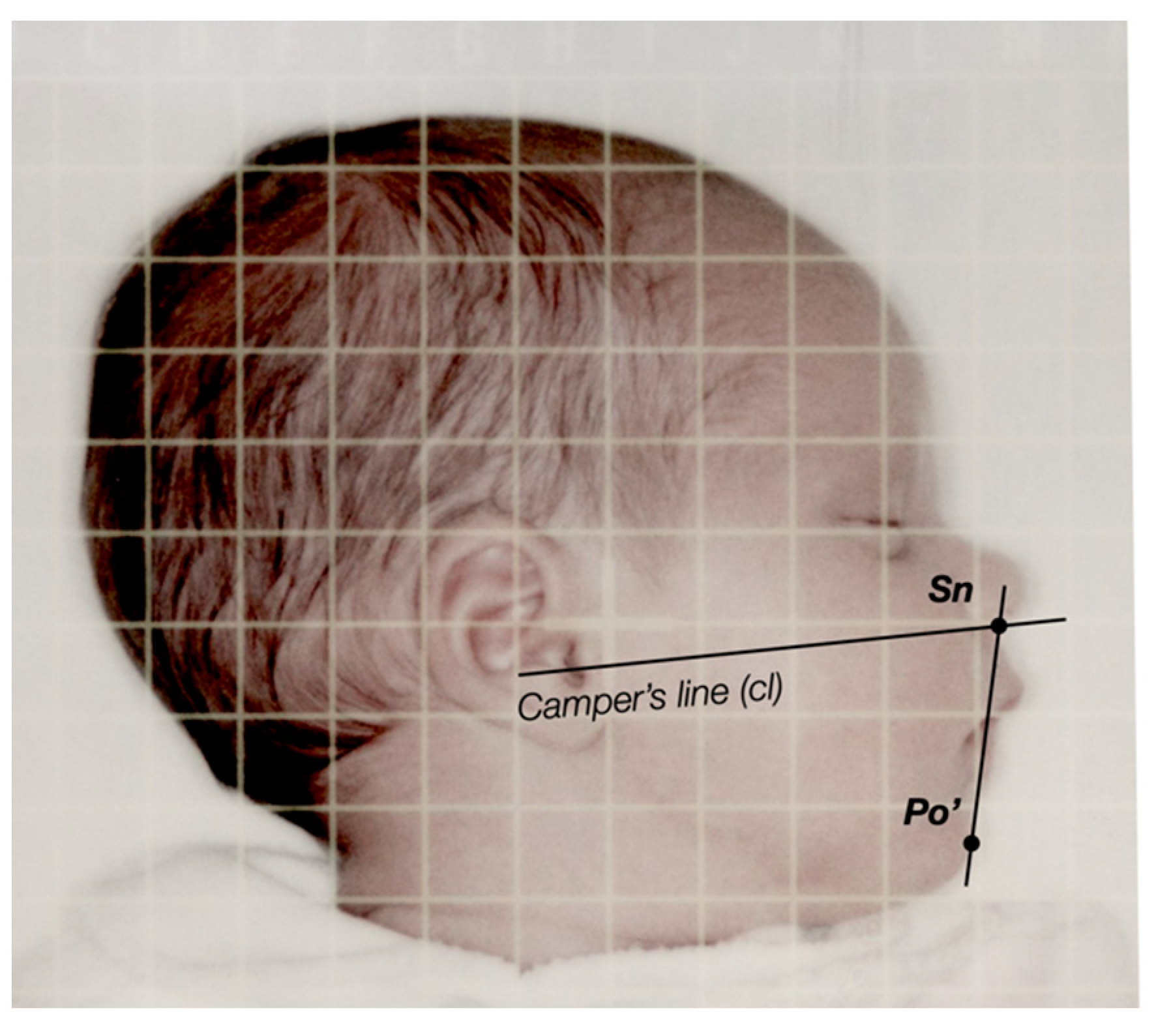 Conformity between Pacifier Design and Palate Shape in Preterm and Term ...
