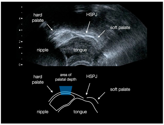 Conformity between Pacifier Design and Palate Shape in Preterm and Term ...