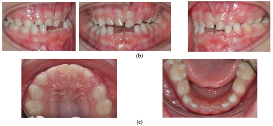 Intercepting of Class III Malocclusion with a Novel Mechanism Built on ...