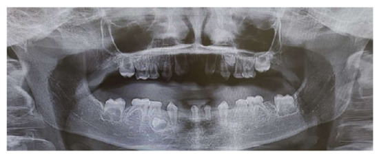 Primary Teeth Supported Fixed Prosthesis—A Predictable Treatment ...