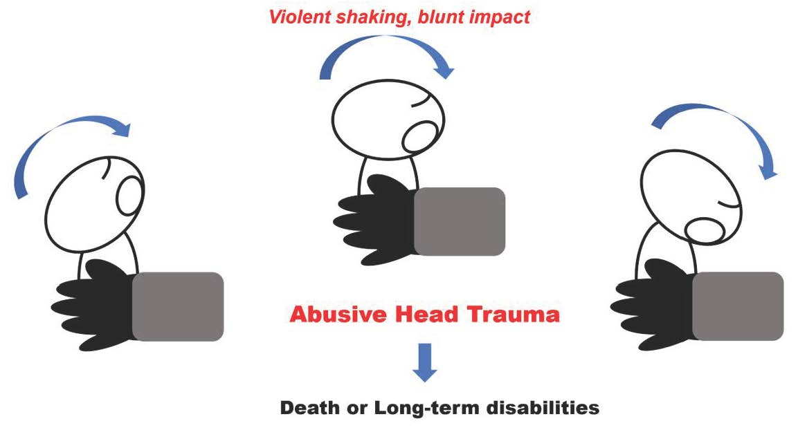 Children | Free Full-Text | Neonatal Abusive Head Trauma without ...