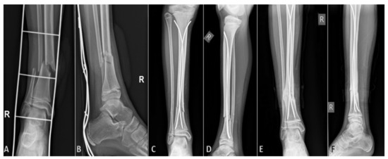 Elastic Stable Intramedullary Nailing for Treatment of Pediatric Tibial Fractures: A 20-Year ...