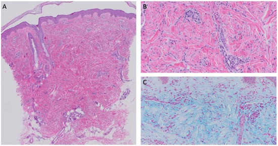 Pediatric Lichen Myxedematosus: A Diagnostic and Management Challenge
