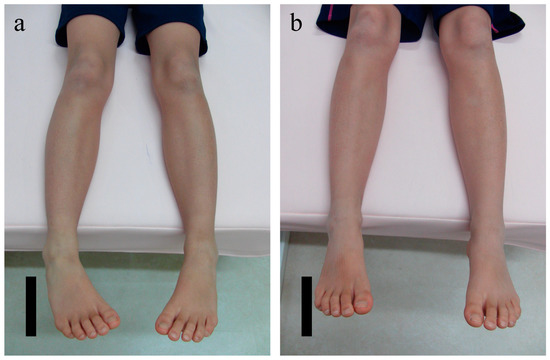 Efficacy of a Tibia Counter Rotator System for the Treatment of ...